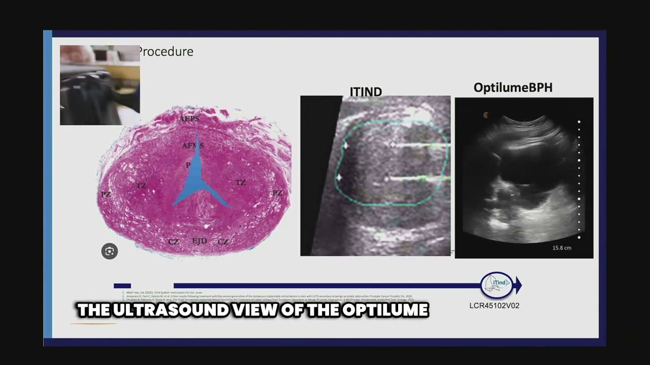 Canadian Benign Prostatic Hyperplasia (BPH) Treatment Centre
